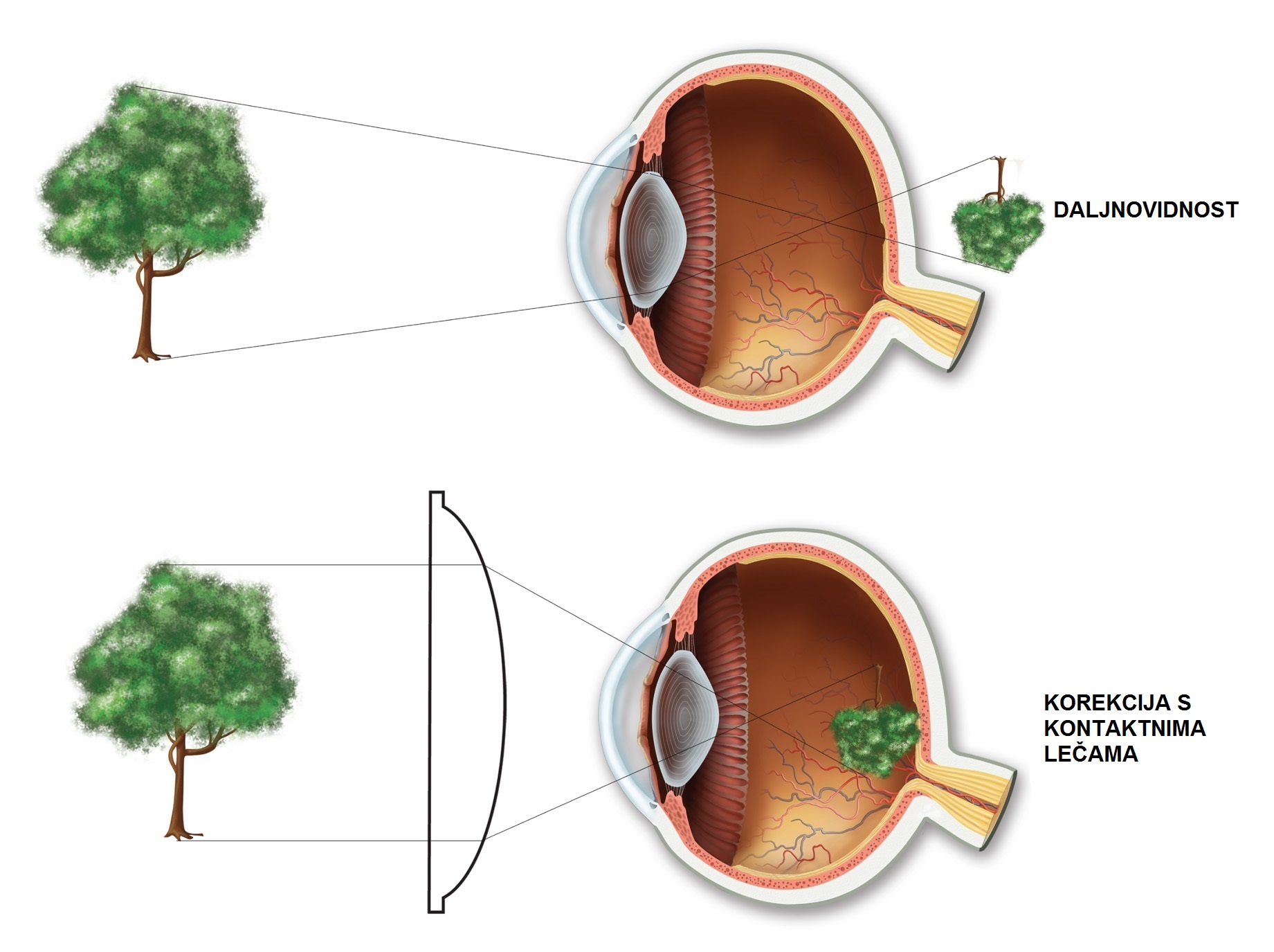 Daljnovidnost (HYPEROPIA)