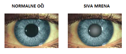 Katarakta Simptomi ELIKSIR : Katarakta, Simptomi I Lečenje (Prilog 4)